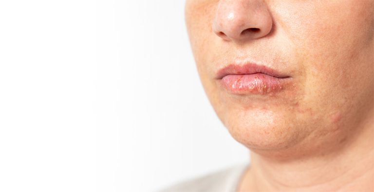 What Are Meth Sores? | Diamond House Detox