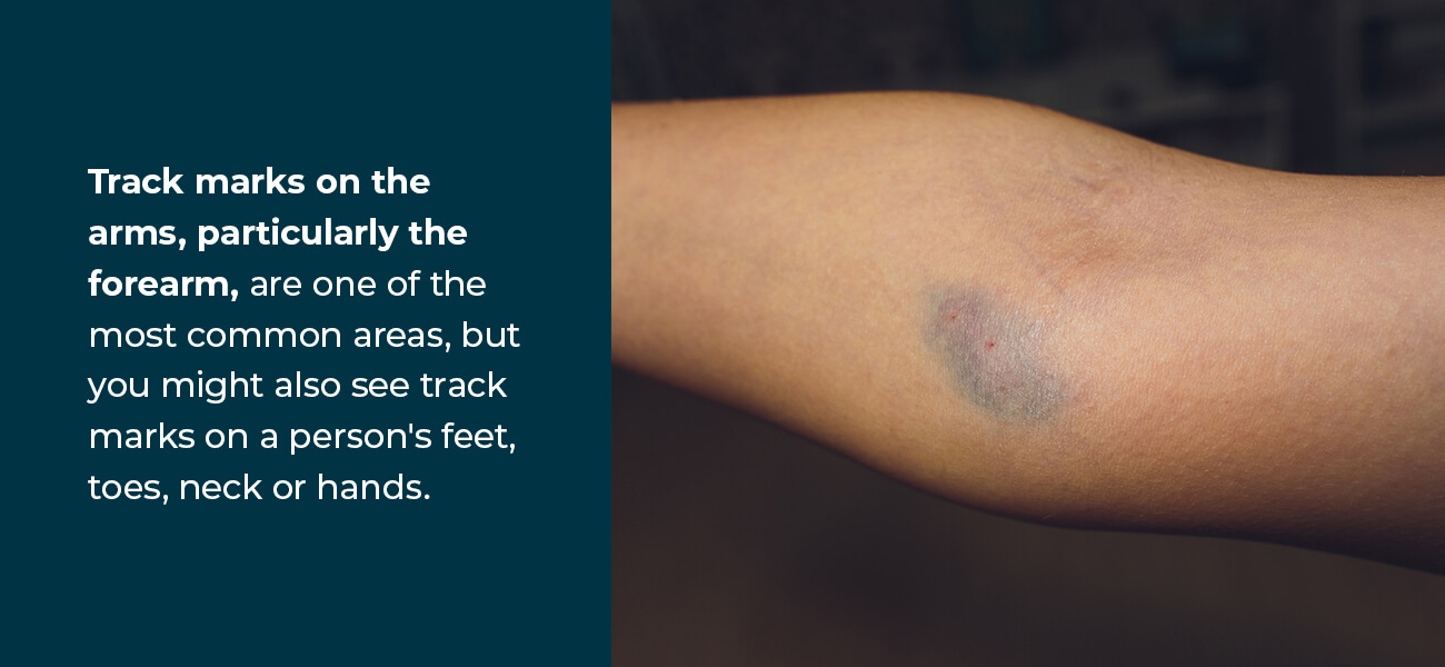 What Are Track Marks On Arms From Shooting Up What Are Track Marks On Arms From Shooting Up